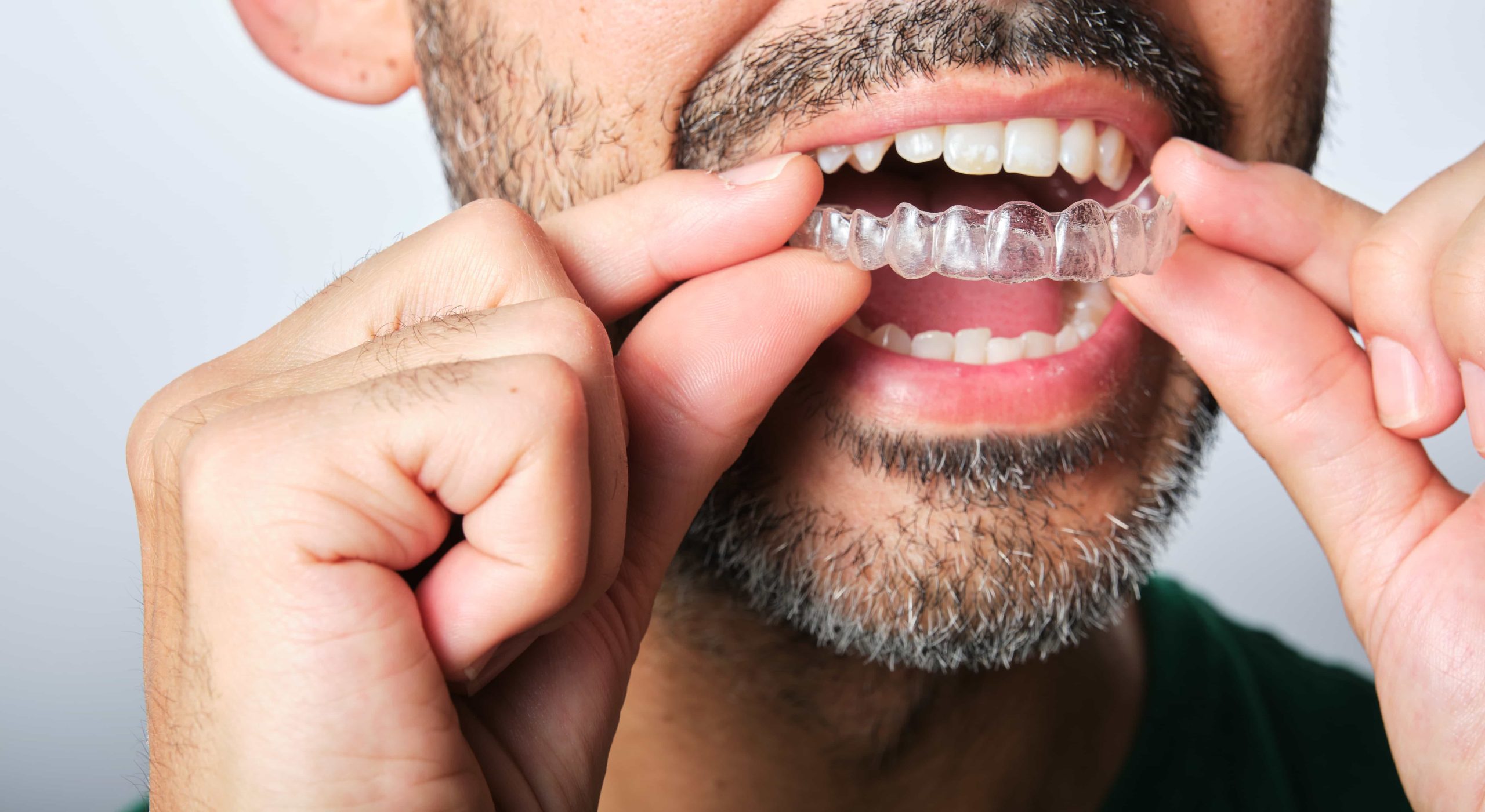 Retenedores Después De Los Brackets Clínica Bérmar